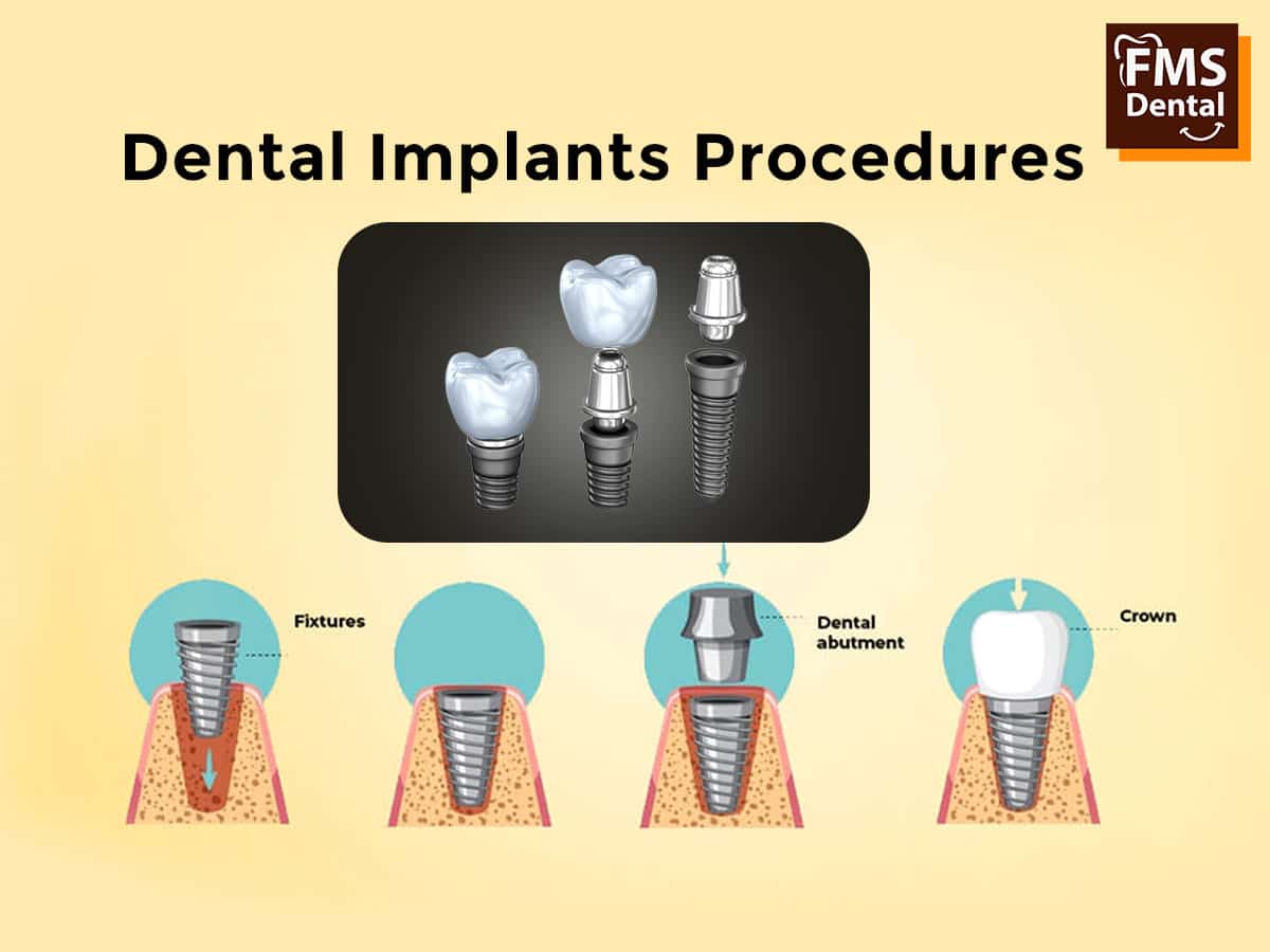 Dental Implants: The Ultimate Solution for Replacing Missing Teeth