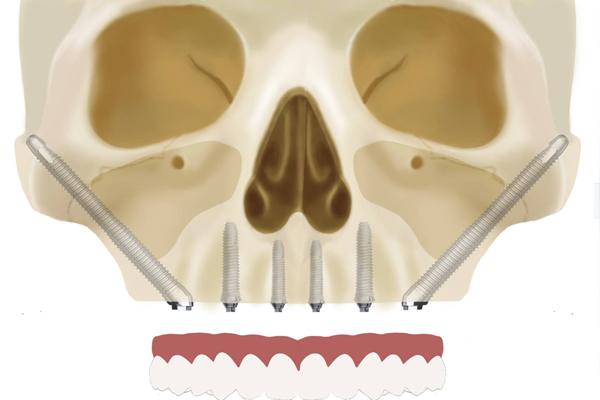 Zygoma Implants | FMS DENTAL HOSPITAL