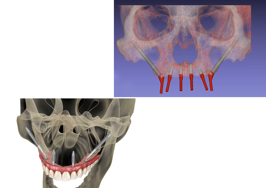 Zygoma Implants | FMS DENTAL HOSPITAL