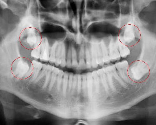 Best Dental Clinic in Chandanagar & Madinaguda, Top Dentist FMS