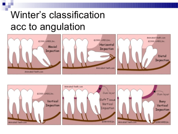 IMPACTED TEETH