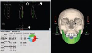 3D JAW TRACKER for TMD | FMS DENTAL HOSPITAL