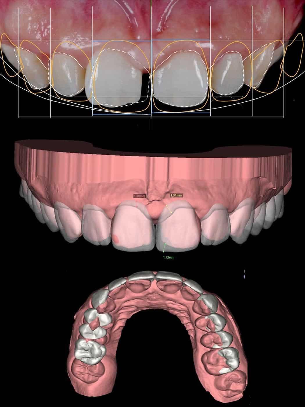 Celebrity Smile Makeover Treatment in Hyderabad India, FMS