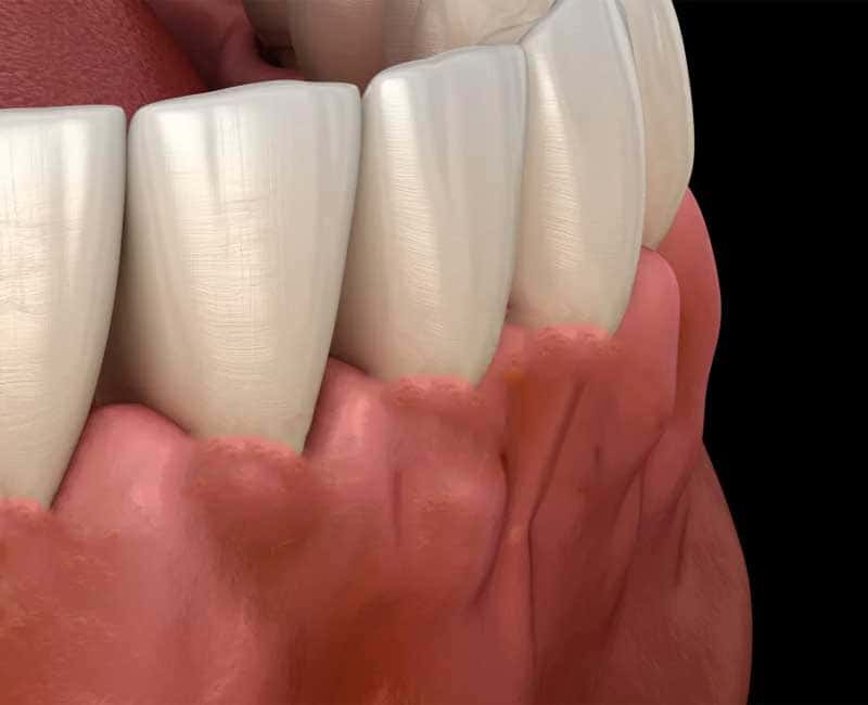 Gum Contouring Treatment in Hyderabad | Gummy Smile Correction