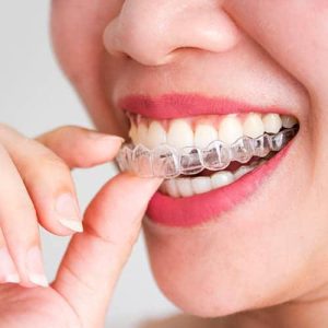 Top Best Invisalign Provider in Hyderabad, India | FMS Dental